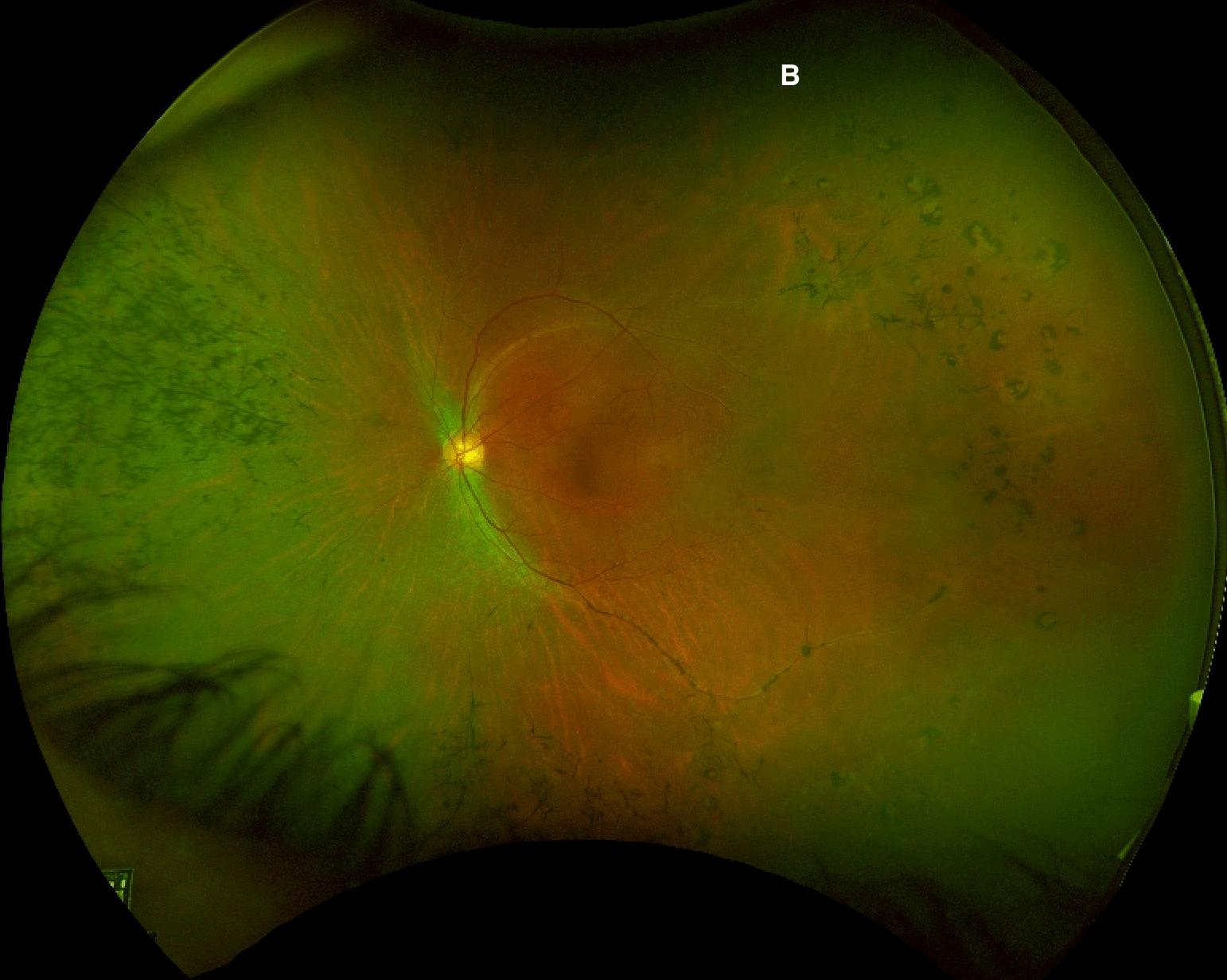 Spotlight Case | Retinitis Pigmentosa Chicago | University Retina