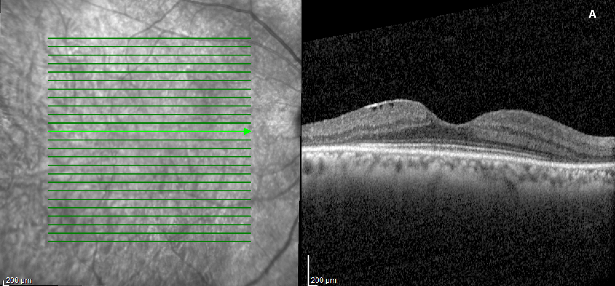 Spotlight Case | Retinitis Pigmentosa Chicago | University Retina