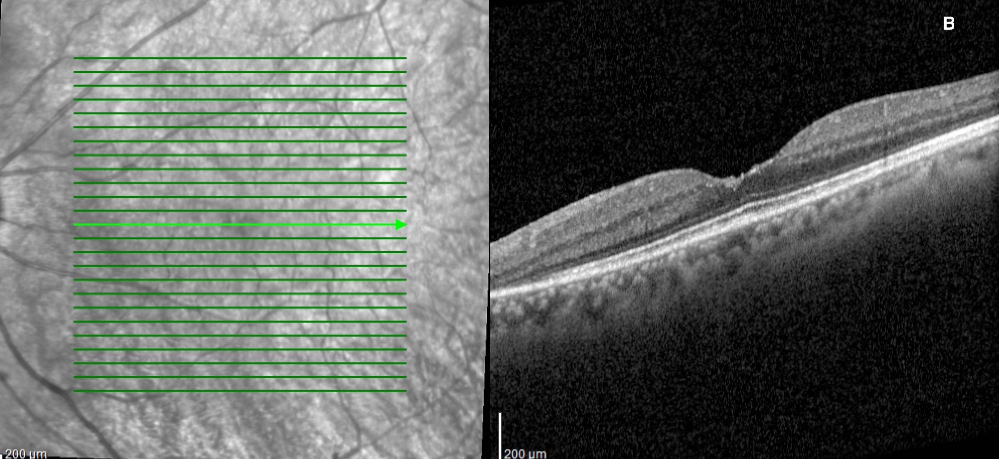 Spotlight Case | Retinitis Pigmentosa Chicago | University Retina