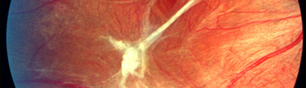 Macular Holes Chicago | Macular Pucker | University Retina